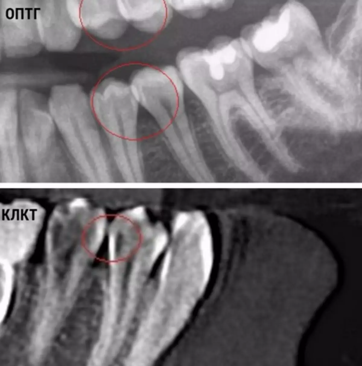 На OPPH, сликите на два заби беа наметнати едни на други (означени со црвен круг), па проблемот остана незабележан. На КТ, истата зона е добиена во друга проекција, без преклопување. Може да се види дека на страничниот ѕид на еден од забите има темно дамка. Ова е скриена кашнатска празнина - таа се разви под полнење.
