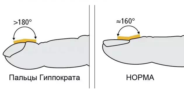 Hvordan bestemme helsetilstanden på neglene (11 tegn) 9022_9