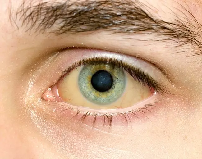 Mata itu dapat menceritakan tentang kesehatan Anda 9175_12
