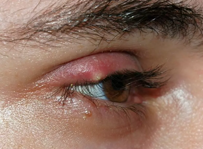 8 болести, които могат да кажат на очите ви 9179_1